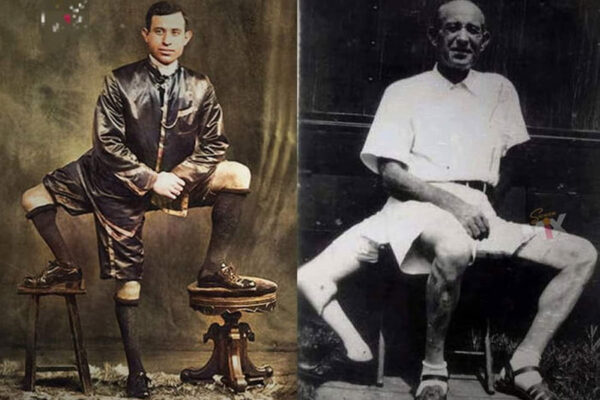 Frank Lentini: The Man With Three Legs, 16 Fingers and Two Penises